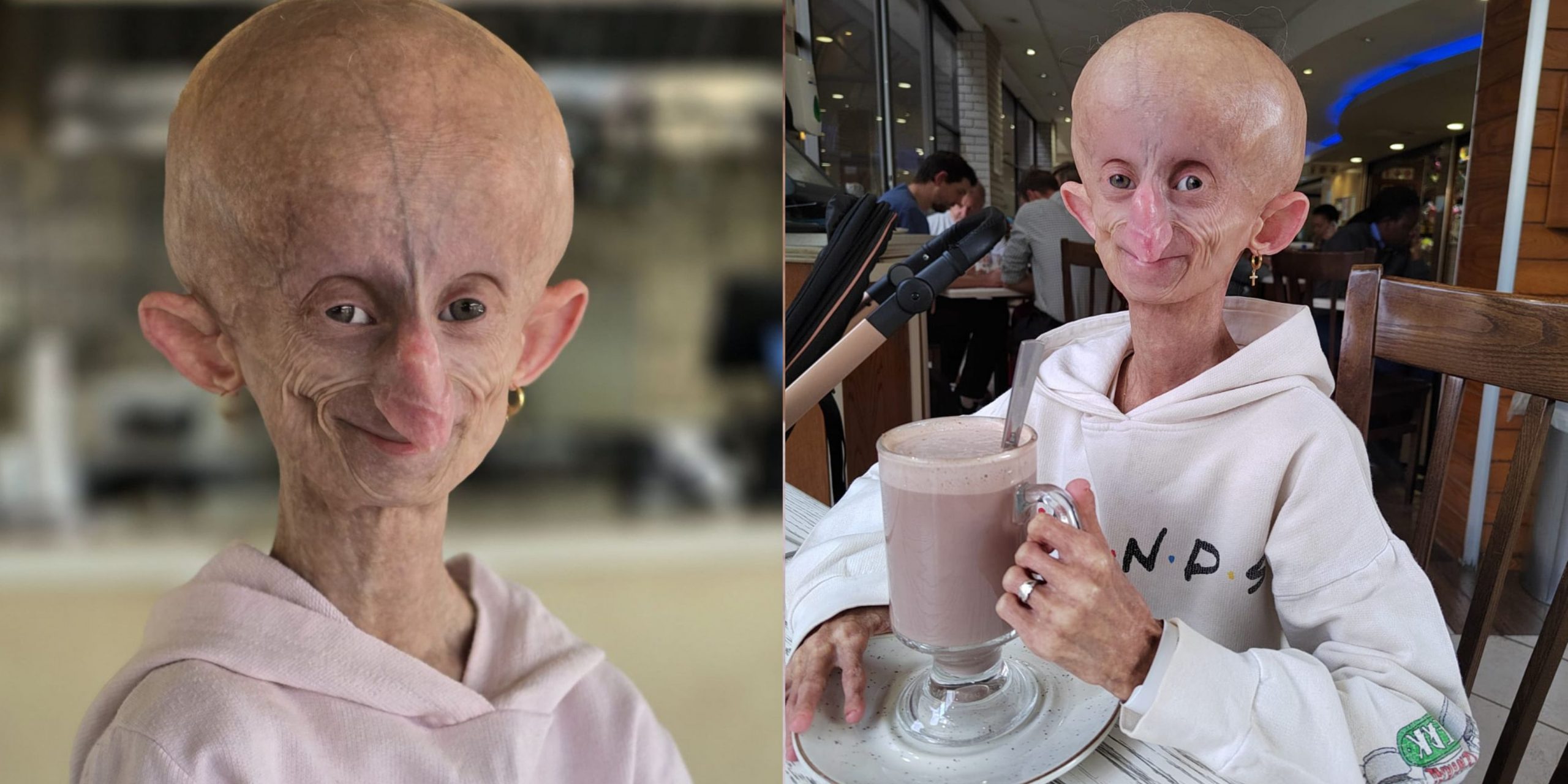 TikTok Star Beandri Booysen Prepares for Life-saving Open-Heart Surgery ...